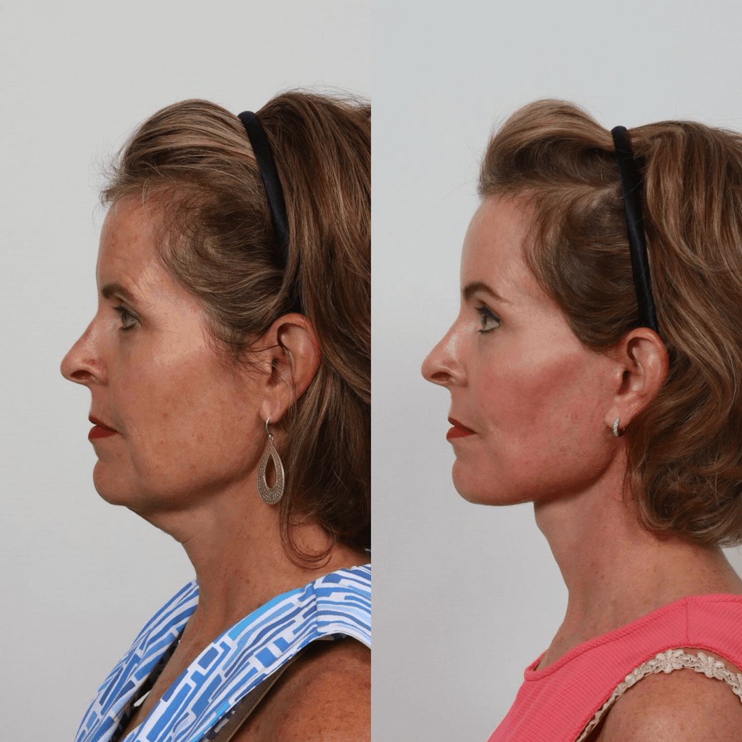 Facial Plastic Surgery Denver | Garrett Locketz, MD