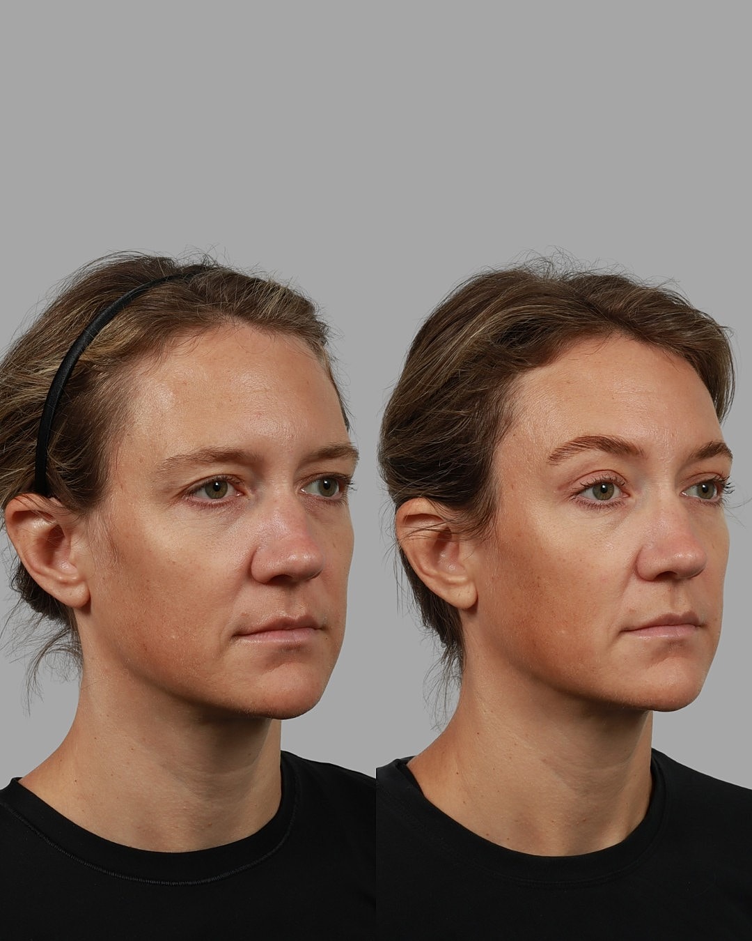 Before & afters | Brow Lift | Patient 7