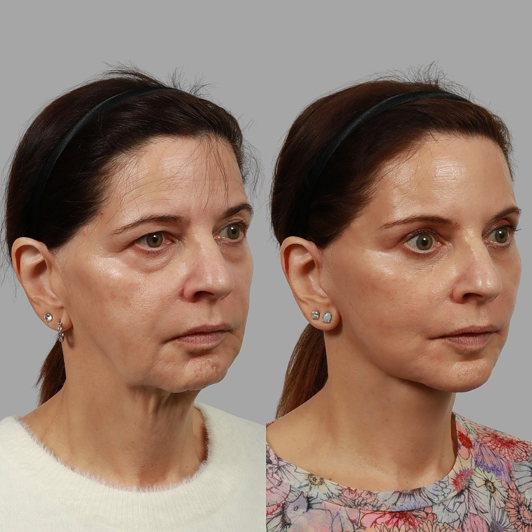 Deep Plane Facelift Gallery | Locketz Facial Plastic Surgery